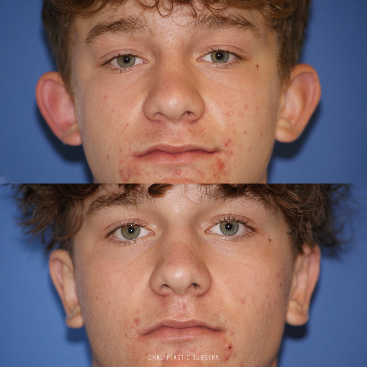 Ear Surgery (Otoplasty) Before & After Pictures - Chau Plastic Surgery